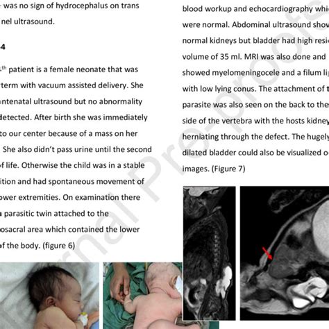 Pdf Rachipagus Parasitic Twins A Case Series And Review Of Literature