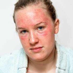 Allergy Patch Allergy Testing Center