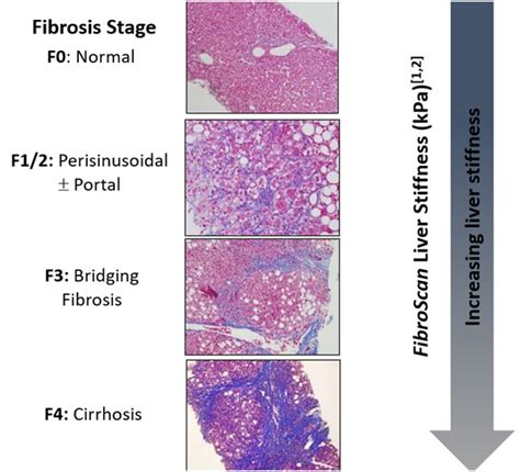 Masld And Fibroscan Liver Elastography Demystified Dr Pathik Parikh