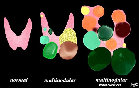 Goiter Multinodular Non Toxic The Common Vein