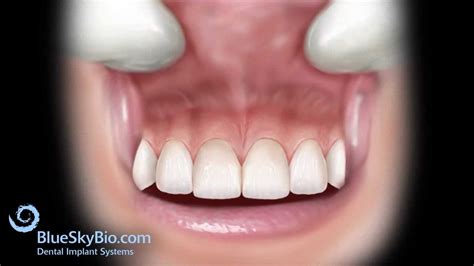 Patient Treatment Videos Frenectomy Youtube