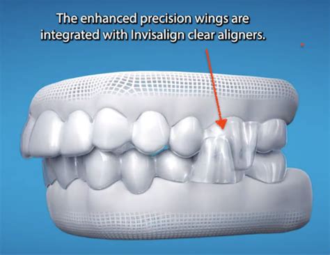 Invisalign Mandibular Advancement Invisalign In Singapore