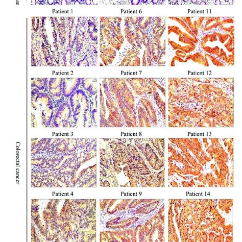 High Expression Of Acy1 Is Associated With Lymph Node Metastasis And