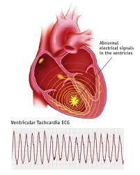 CME Tachyarrhythmia Management Charlie S ED