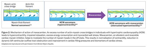 Mavacamten A Novel Treatment For Obstructive Hypertrophic