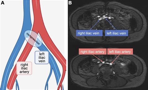 Mri In The Evaluation Of Cryptogenic Stroke And Embolic Stroke Of