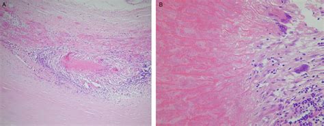 Non Infectious Aortitis Of The Ascending Aorta A Histological And