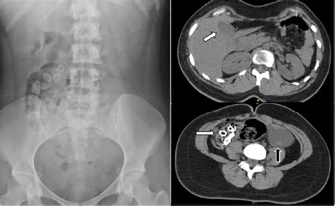 Intestinal Stones A Rare Cause Of Bowel Obstruction Pmc