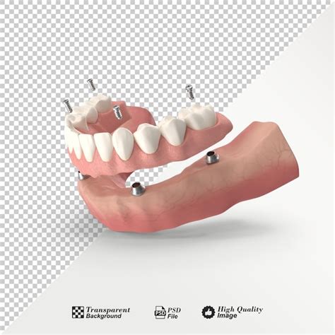 Premium Psd Implant Supported Denture