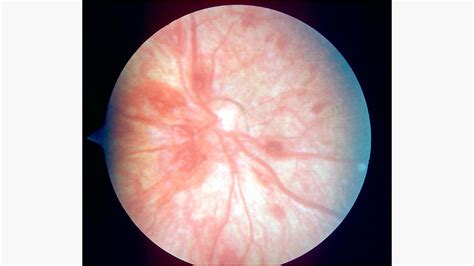Retinal Hemorrhage Hypertension