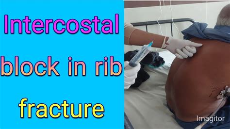 Intercostal Block Method Youtube