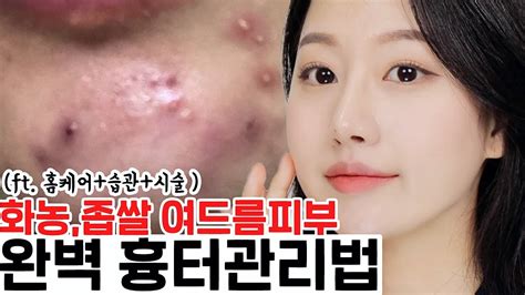 Subs 여드름피부 흉터없애는법⁉️ 무조건 이렇게 하세요‼️ 심한 화농성 여드름 흉터관리비법 ㅣ시술홈케어습관 L 인보라inbora Youtube