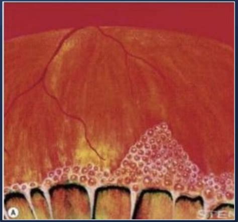 Peripheral Retinal Lesions Dr Yang Flashcards Quizlet