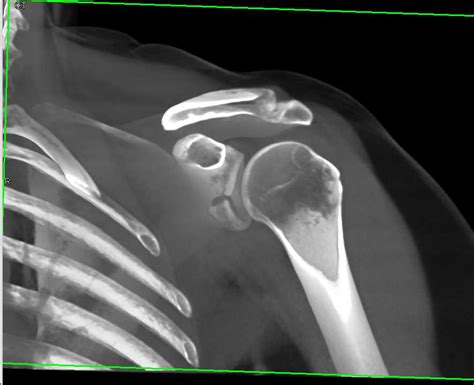 Inferior Glenoid Fracture X Ray At Elvira Pierce Blog