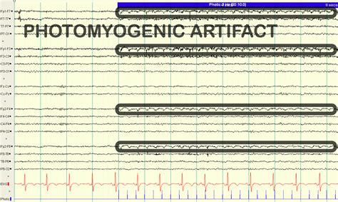 Photomyogenic Artifact