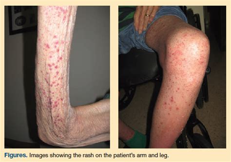 What Is This Rash In An Elderly Long Term Care Resident