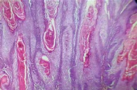 Epithelium Showing Exophytic And Endophytic Growth With Parakeratin