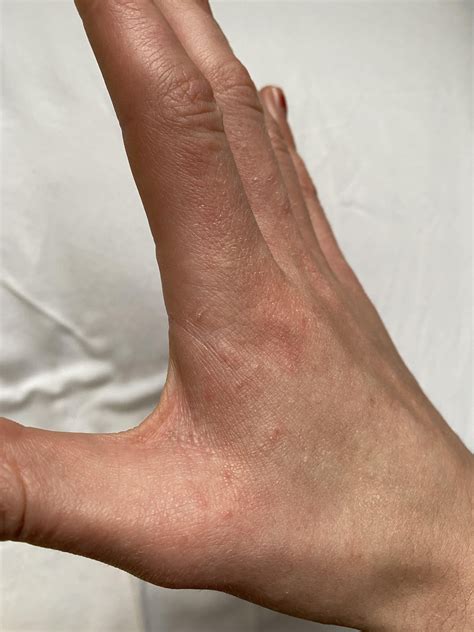 Scabies Or Post Scabies Rscabies