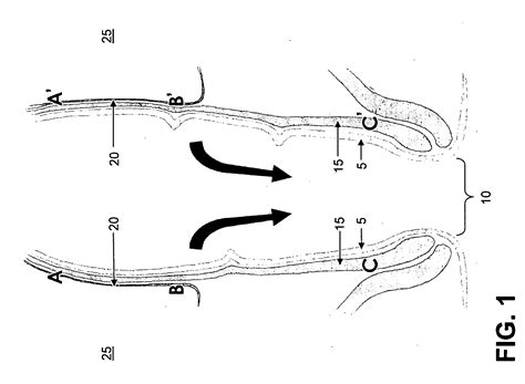 Rectal Prolapse Patented Technology Retrieval Search Results Eureka