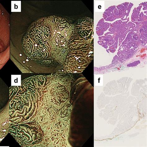 Diagnostic Tree Model Using The Jnet Classification And Pit Pattern