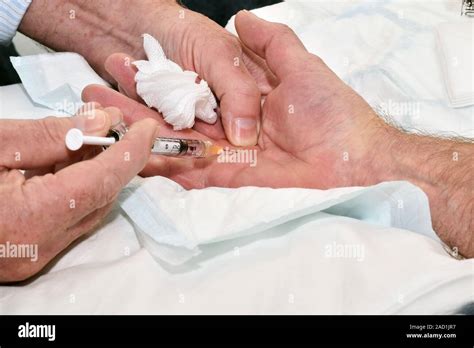 Dupuytren S Contracture Treatment Injection Of Collagenase Into The