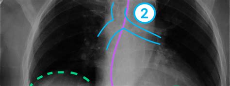 RAIQC Packages Package Nasogastric Tube Position On Chest X Ray