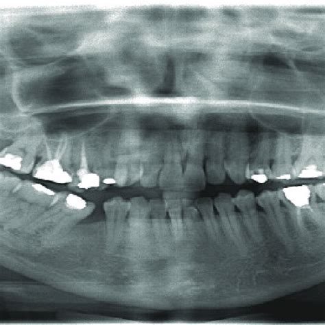 Pdf Evaluation Of Styloid Process Morphology And Calcification Types In Both Genders With