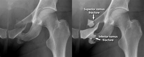 Pelvic Fracture X Ray