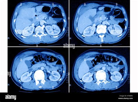 Ct Scan Abdomen High Resolution Stock Photography And Images Alamy