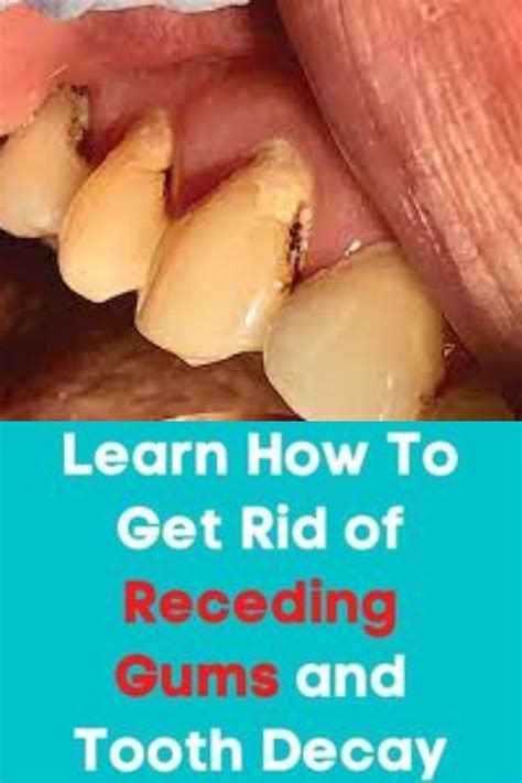 Reverse Receding Gums Artofit