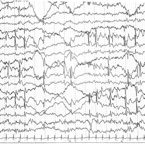 Video Eeg Recording Revealing Epileptiform Activity Frequently Download Scientific Diagram