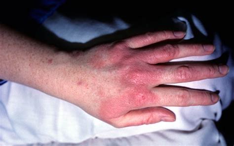 Contact Dermatitis Treatments Symptoms And Prevention Healthdirect