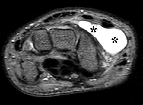 Wrist Ganglion Cysts Radsource
