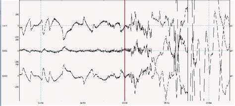 2 3 Typical Example Of Movement Artefacts Observed In Eeg Activity Download Scientific Diagram