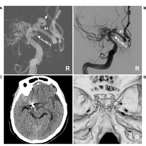 Figure Angioarchitecture Of Twig Like Mca A Two Dimensional Dsa Of Download Scientific Figure Angioarchitecture Of Twig Like Mca A Two Dimensional Dsa Of Download Scientific