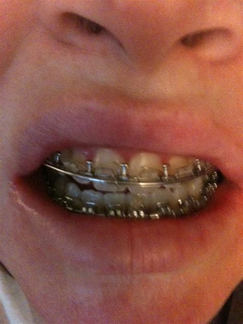 Smile Braces And Double Jaw Surgery My Journey You Shouldnt