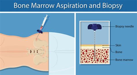 Improving Patient Experience During Bone Marrow Biopsies By The Dice Group Jul 2020 Medium