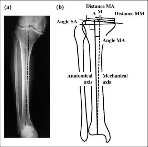 Proximal Tibia Anatomy