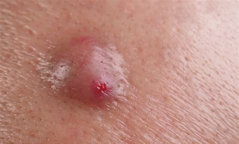 Ingrown Hair Prevation Of Ingrown Or Encapsulated Hair