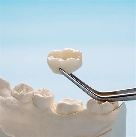 Porcelain Crowns