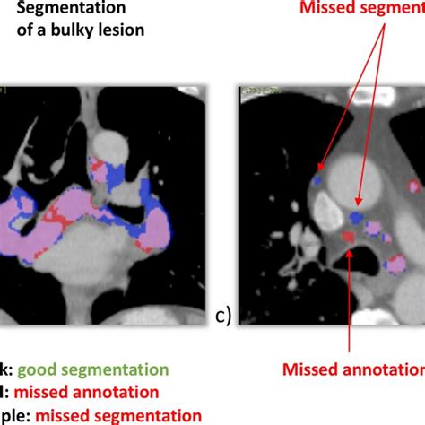Examples Of Ground Truth And Predicted Segmentations A Optimal Ln Download Scientific Diagram