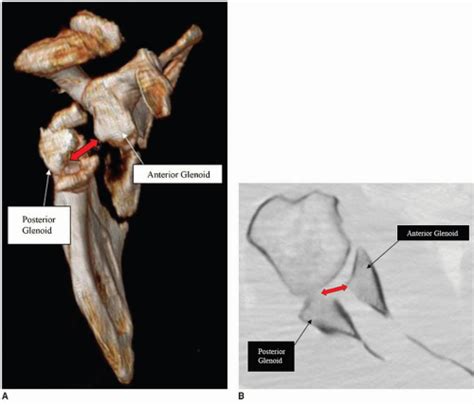 Scapula Fractures Open Reduction Internal Fixation Musculoskeletal Key