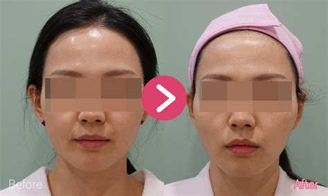 팔자주름 리프팅 1 레이디한의원