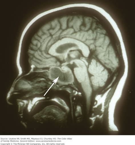 Sinusitis Basicmedical Key