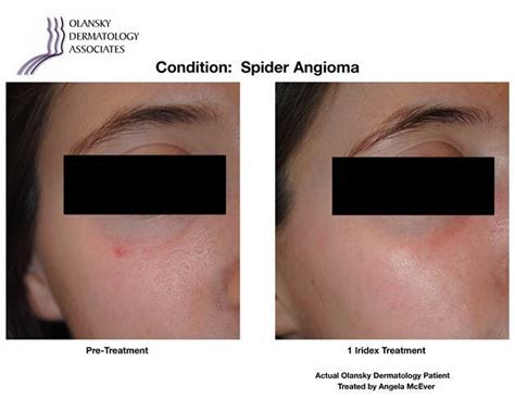 Atlanta Cherry Angioma Before And After Photos