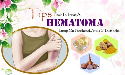 23 Tips How To Treat A Hematoma Lump On Forehead Arms And Buttocks