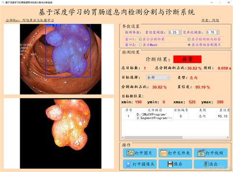 基于yolo11深度学习的胃肠道息肉智能检测分割与诊断系统【python源码 pyqt5界面 数据集 训练代码】深度学习实战、目标分割、人工