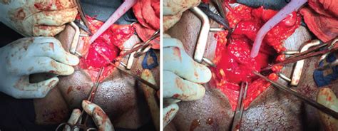 Open Surgical Repair Of Multiple Bladder Diverticula Download Scientific Diagram