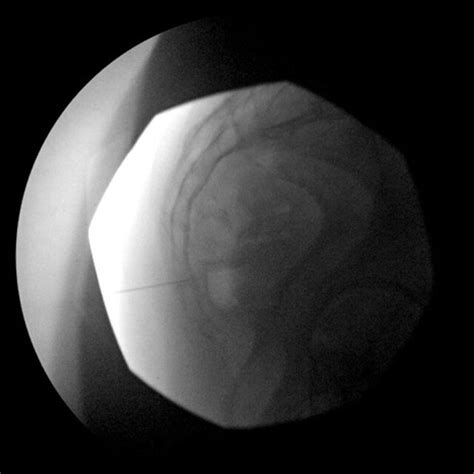 Fluoroscopic Image Before Contrast Agent Injection Download Scientific Diagram