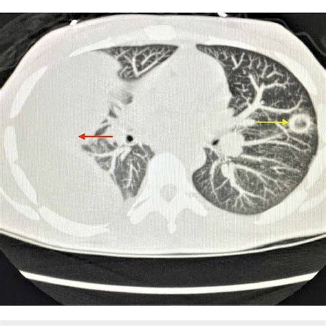 Reformatted Ct Chest Without Contrast Showing Right Sided Loculated